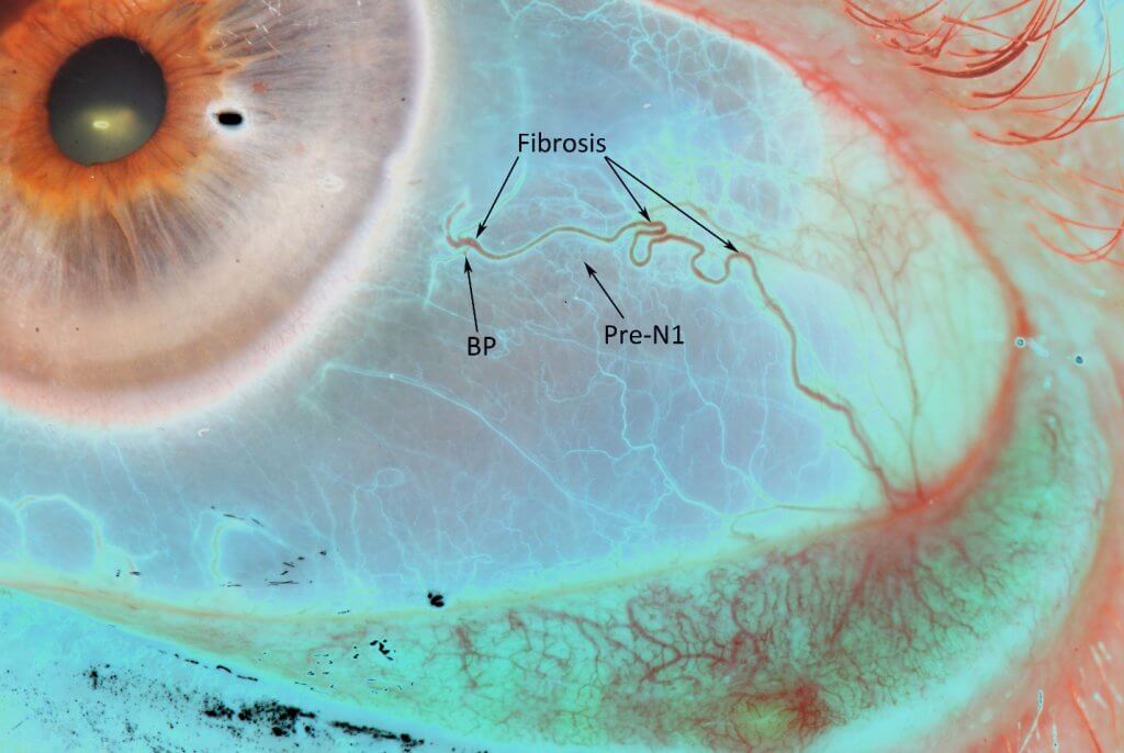 SCLEROLOGY BASICS COURSE – Grand Medicine Eyology | Iridology
